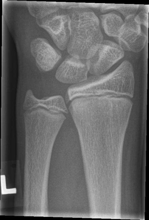 fracture detection Object Detection Dataset and Pre-Trained Model by Alex