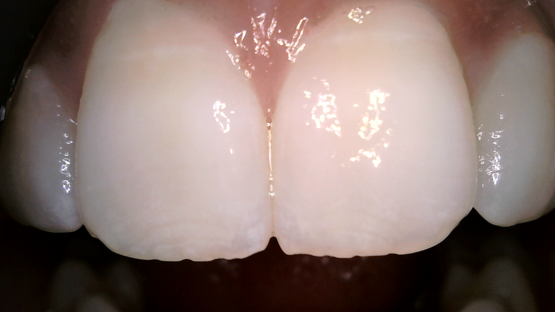 Tooth_Gums Instance Segmentation Dataset and Pre-Trained Model by teeth