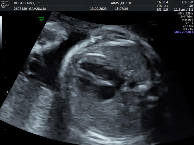 How to Use the fetus heart ultrasound Object Detection API