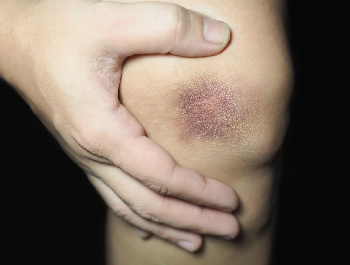 bruise detector Object Detection Dataset and Pre-Trained Model by ...