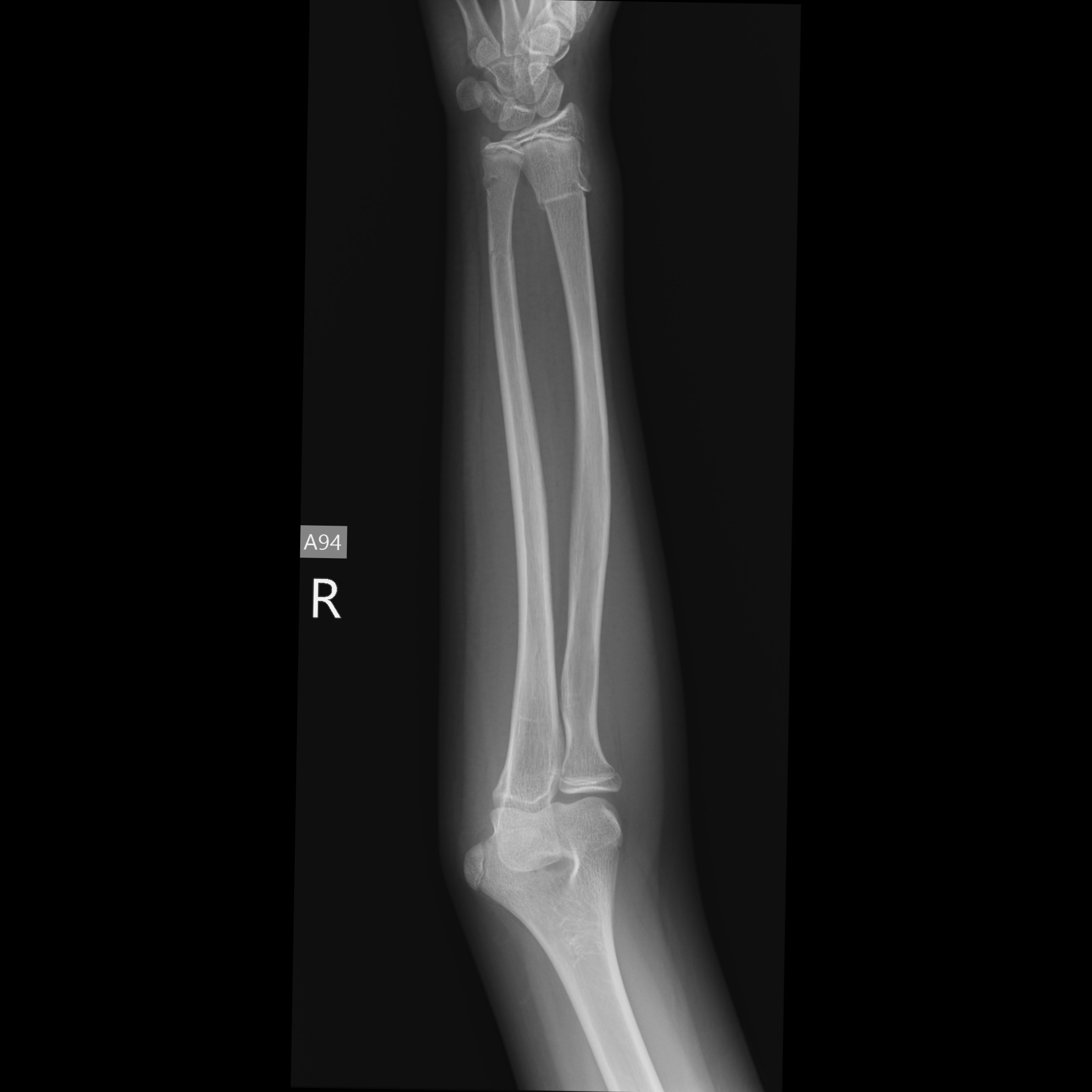 Bone Fracture Object Detection Dataset V4 2023 11 27 3 27pm By Kmutnb