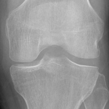 Knee OA Dataset1 Classification Dataset by Helen Jiang