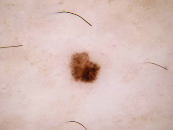 Skin Cancer Object Detection Dataset by Skin Cancer