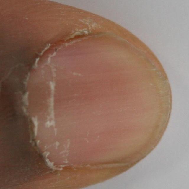 normal nails Object Detection Dataset and Pre-Trained Model by Nail