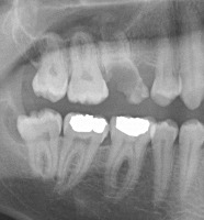 Dental Caries Detection-Deneme Semantic Segmentation Dataset and Pre-Trained Model by Panoramic ...