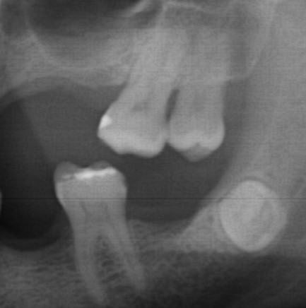 Dental Caries Detection-Deneme Semantic Segmentation Dataset (v1, 2023-04-25 6:59pm) by ...