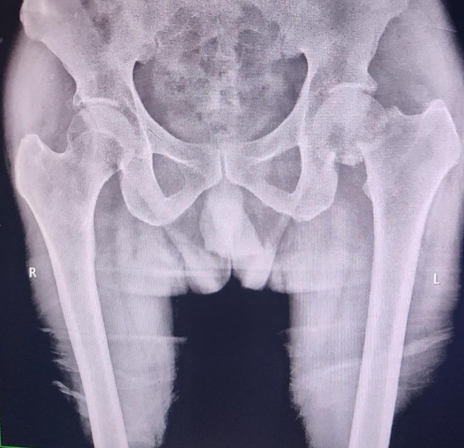 How to Use the Proximal Femur Fracture Instance Segmentation API