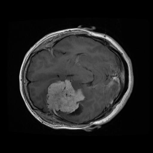 brain tumor detection Object Detection Dataset by Selvacsecit brain tumor detection Object Detection Dataset by Selvacsecit