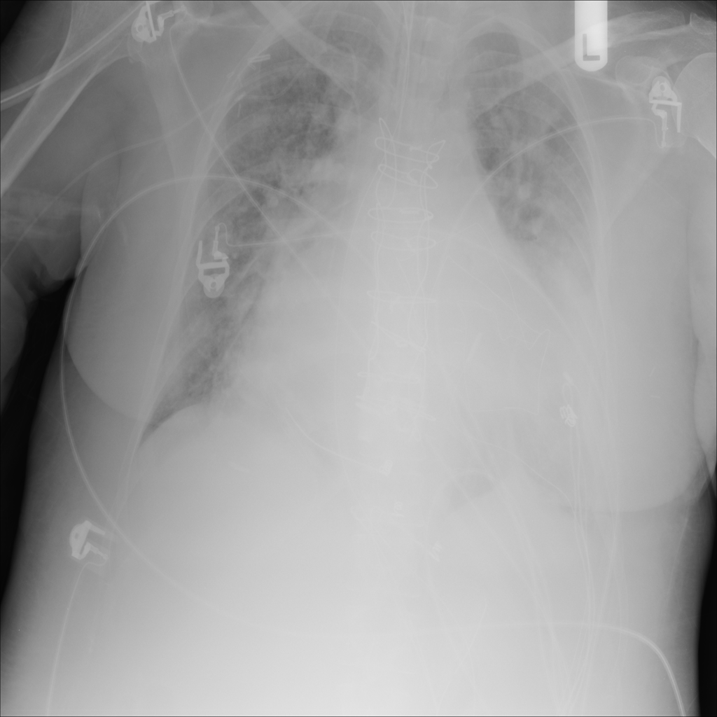 NIH-Xray Object Detection Dataset by Edesak NIH-Xray Object Detection Dataset by Edesak