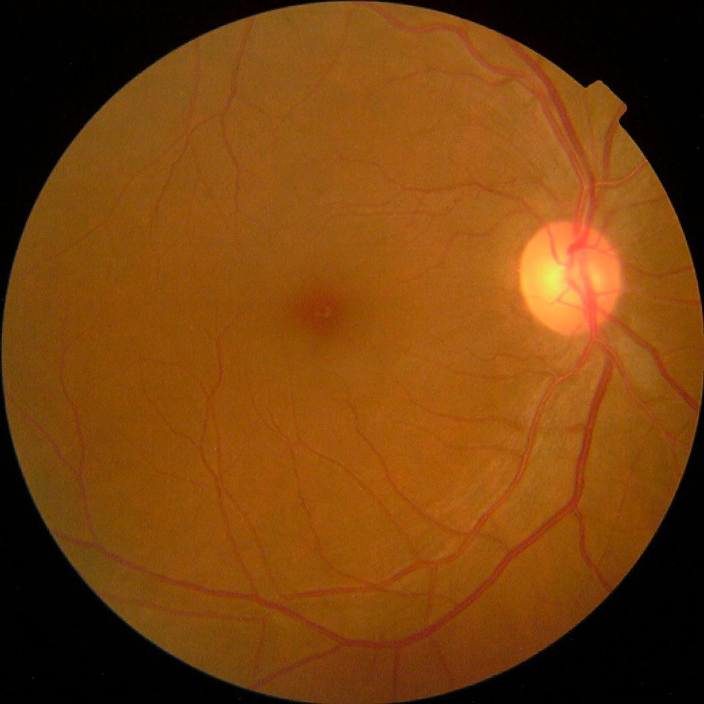 Optic Disc Detection Object Detection Dataset And Pre Trained Model By Opticdisc