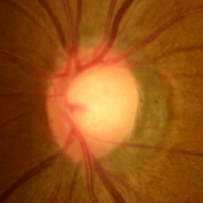 glaucoma detection Classification Dataset and Pre-Trained Model by PSIT