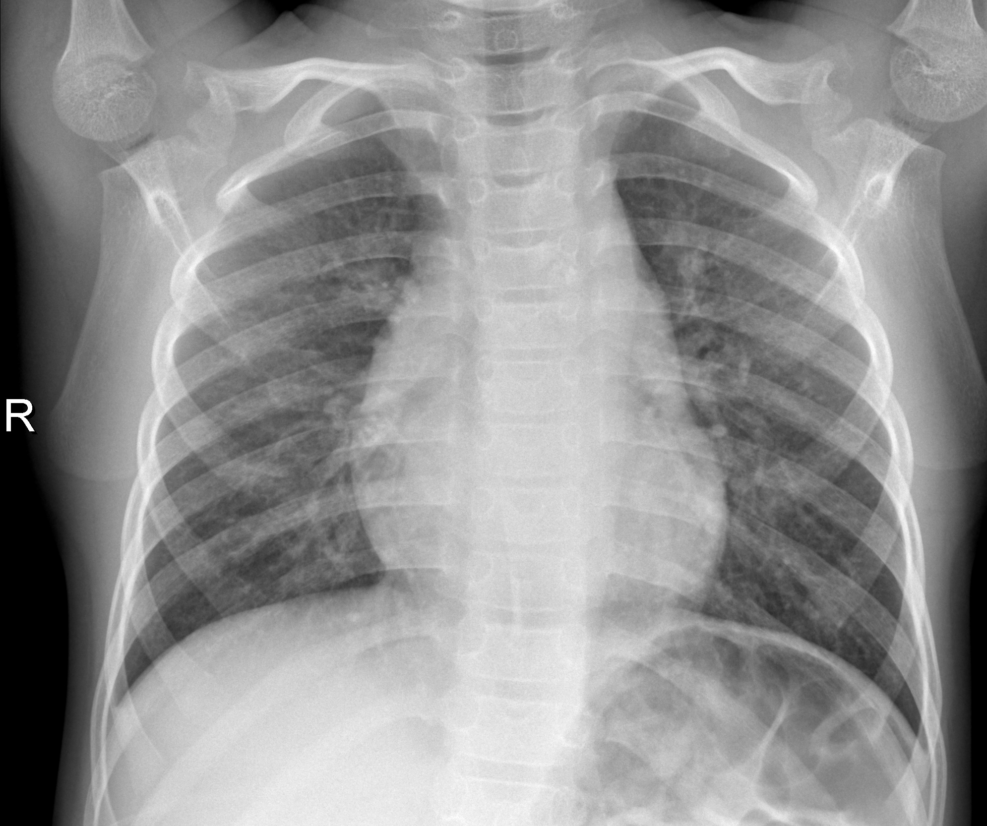 pneumonia Object Detection Dataset and Pre-Trained Model by Annie