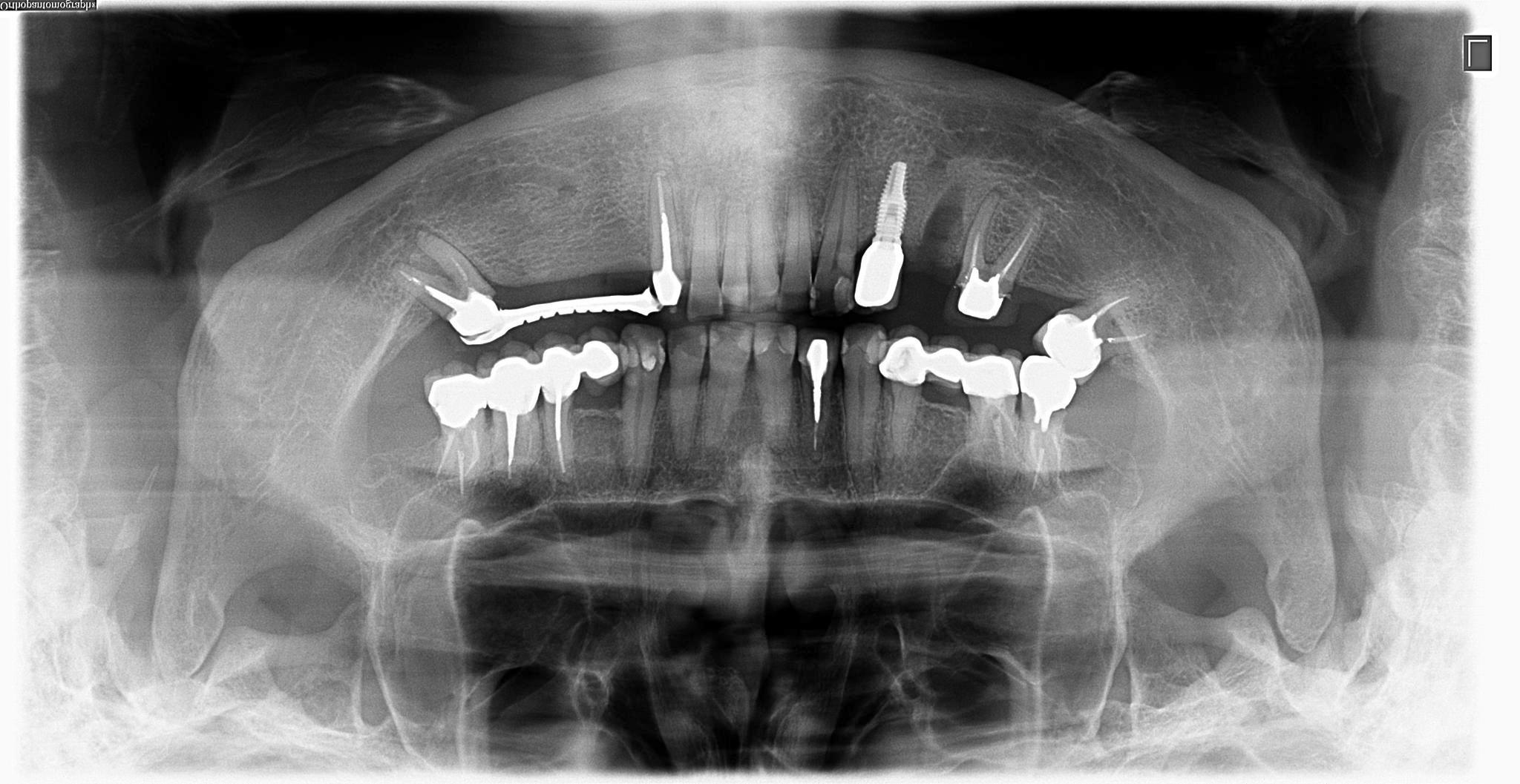 Implants Augmentation V4 2 Computer Vision Dataset By Tcc Workspace