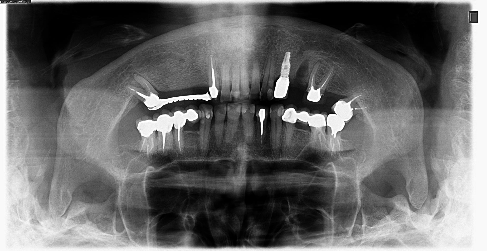 Implantes Augmentation 2 Object Detection Dataset By Tcc Workspace