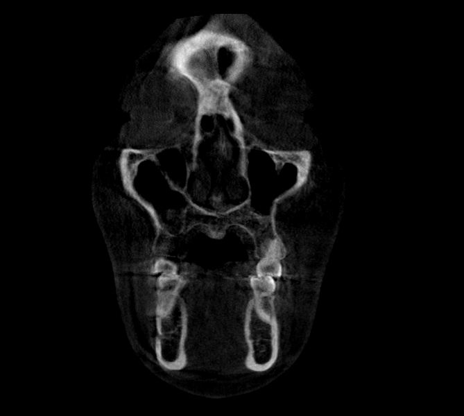 Proj_OSD_bbox_tooth_bone Object Detection Dataset by OSD Project