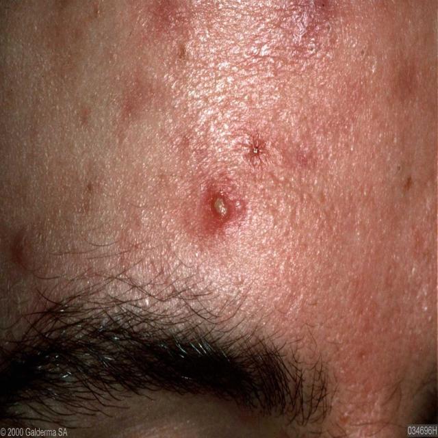 Acne Object Detection Dataset by Sd