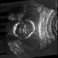 Fetal Brain Abnormalities Ultrasound Classification Dataset and Pre-Trained Model by Hritwik Trivedi