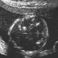 Fetal Brain Abnormalities Ultrasound Classification Dataset and Pre-Trained Model by Hritwik Trivedi