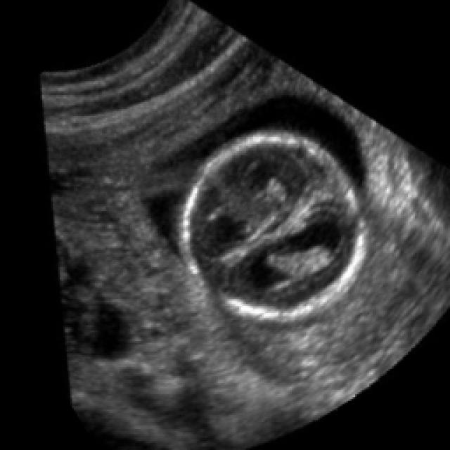 Fetal Brain Abnormalities Ultrasound Classification Dataset and Pre-Trained Model by Hritwik Trivedi