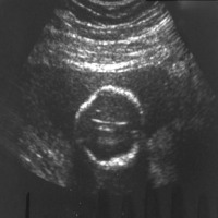 Fetal Brain Abnormalities Ultrasound Classification Dataset and Pre-Trained Model by Hritwik Trivedi