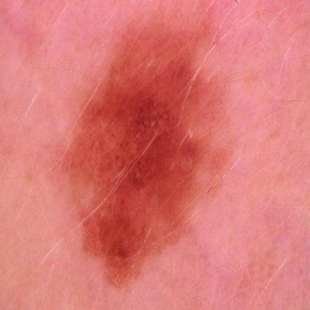 Skin cancer Object Detection Dataset and Pre-Trained Model by Smart ...