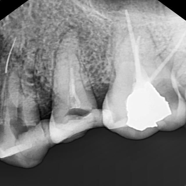 Dental Caries Classification Classification Dataset And Pre Trained Model By Dental Caries