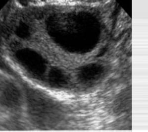 Pcos detection Object Detection Dataset and Pre-Trained Model by ...