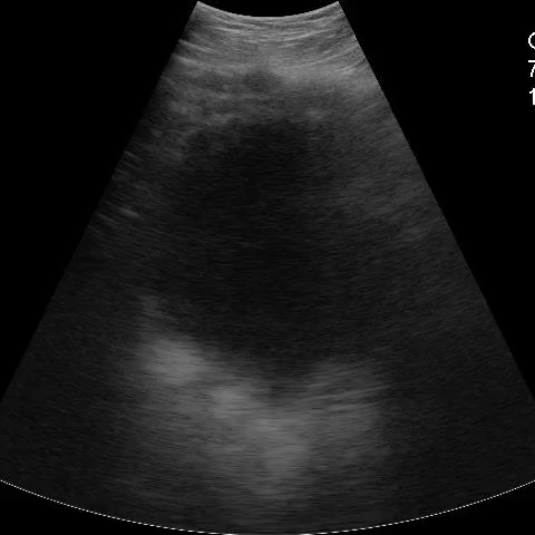 Bladder Finder Object Detection Dataset and Pre-Trained Model by DHIP ...