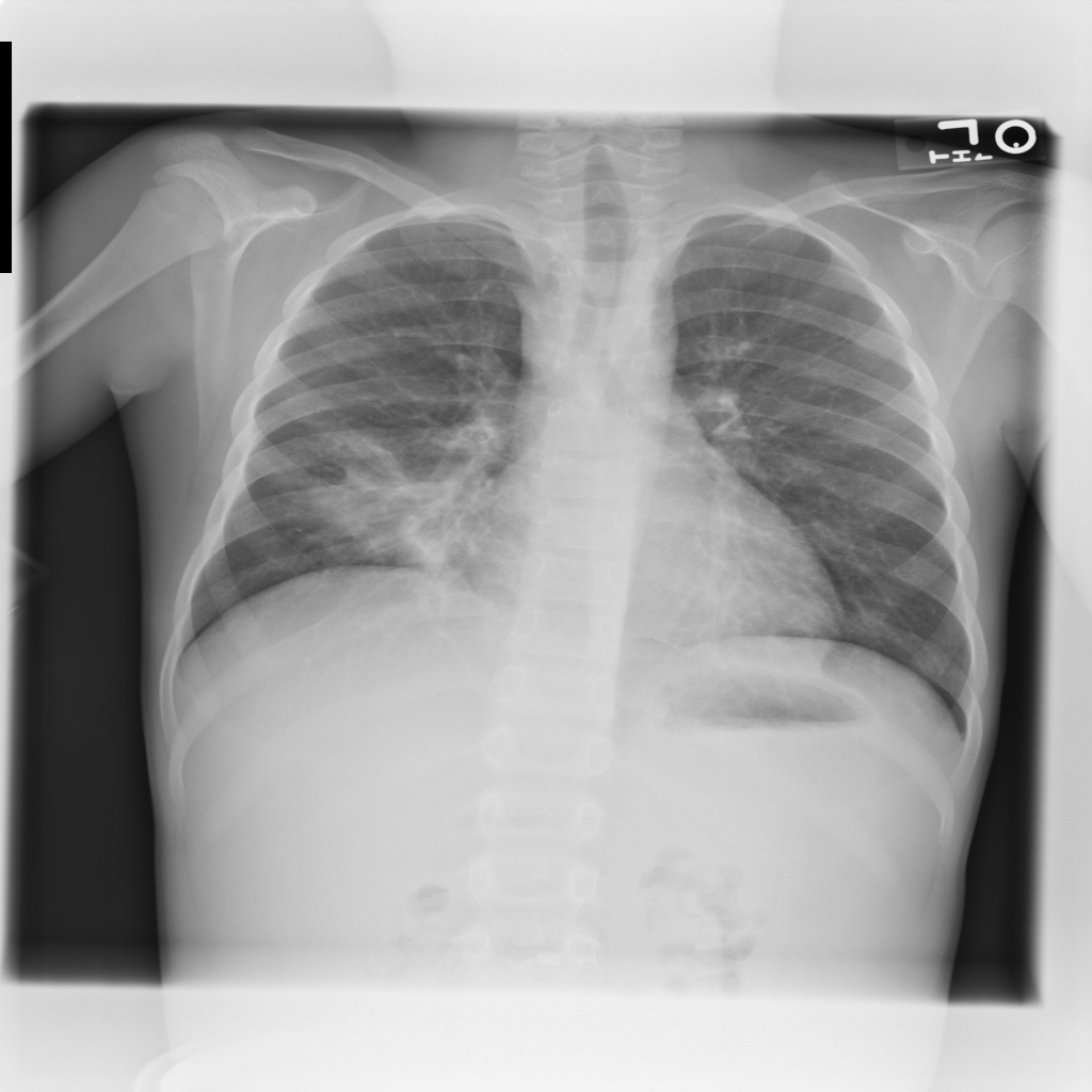 Cxr Object Detection Dataset And Pre Trained Model By Andrew White
