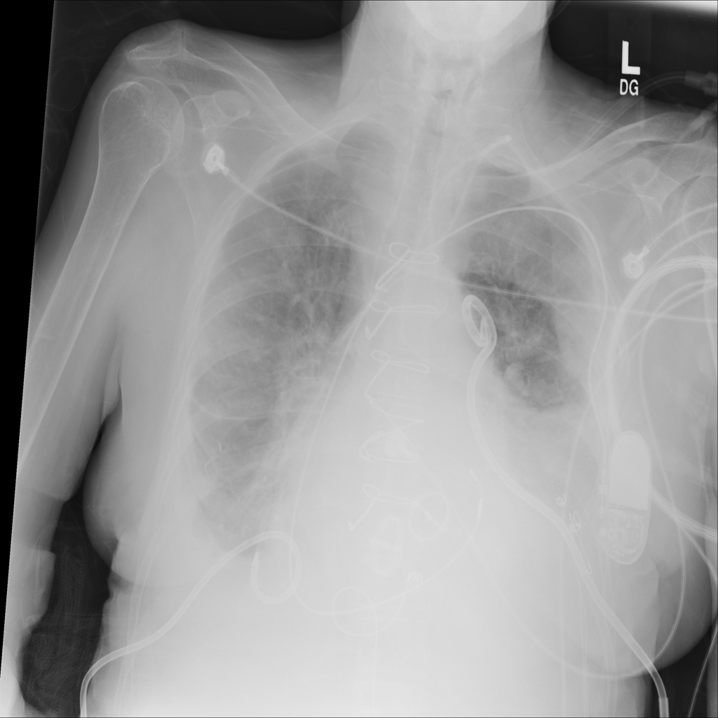 CXR BIG Object Detection Dataset by Andrew White