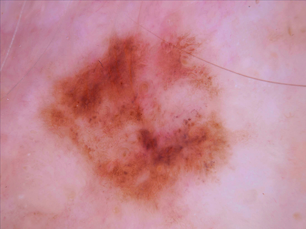 RASH Object Detection Dataset and Pre-Trained Model by Andrew White