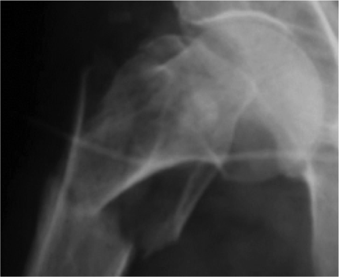 Hip Fracture Detection Object Detection Dataset And Pre Trained Model