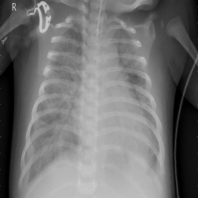 pneumonia Classification Dataset and Pre-Trained Model by class