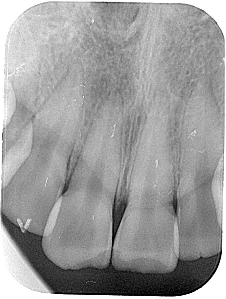 periapical_ust_aug_valid Object Detection Dataset by cranioo
