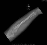 bone fracture Object Detection Dataset and Pre-Trained Model by ...