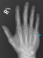 bone fracture Object Detection Dataset and Pre-Trained Model by ...