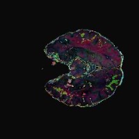 brain tumor Object Detection Dataset and Pre-Trained Model by Roboflow 100