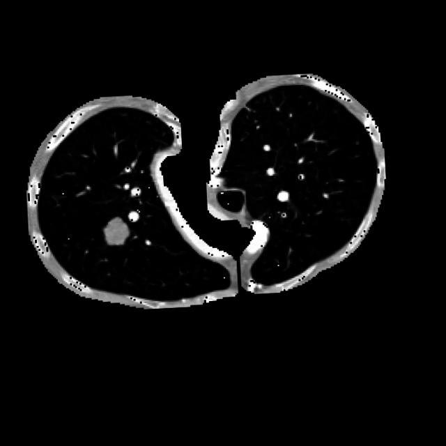 lung_nodule_detection using yolo v8 Object Detection Dataset and Pre ... lung_nodule_detection using yolo v8 Object Detection Dataset and Pre ...