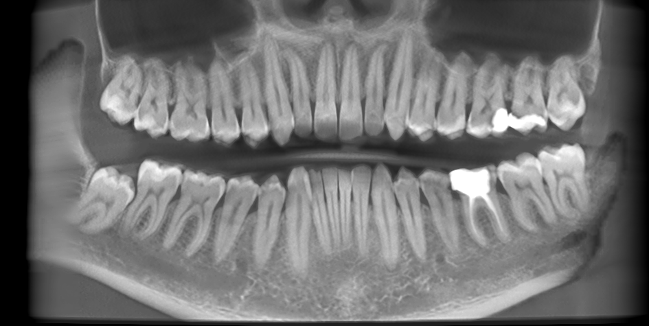 rentgen teeth Instance Segmentation Dataset and Pre-Trained Model by Gleb Bondarchuk