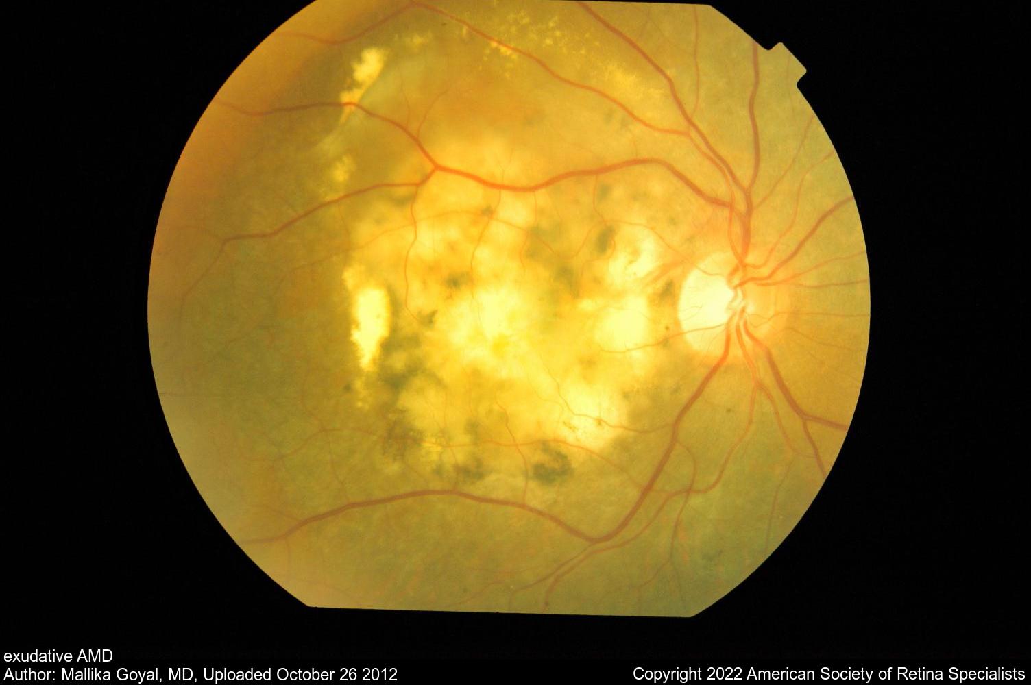 YOLO-AMD Object Detection Dataset and Pre-Trained Model by hrdproject