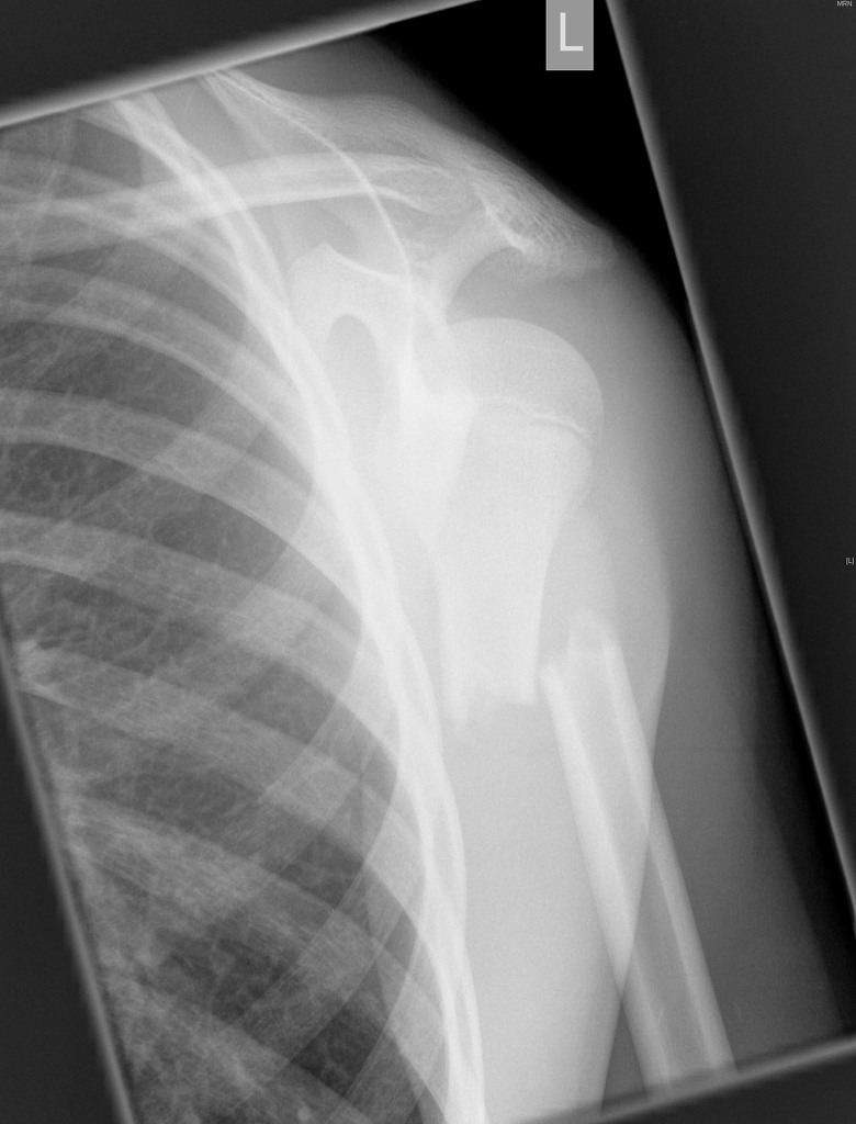 Science Research 2022 Bone Fracture Detection V3 Object Detection