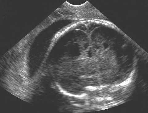 Fetal brain instance segmentation Instance Segmentation Dataset by CV