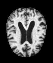 Alzheimer Dataset Object Detection Dataset by Seojin Jang