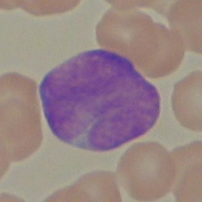 AML Detection Object Detection Dataset and Pre-Trained Model by BOmerDogan