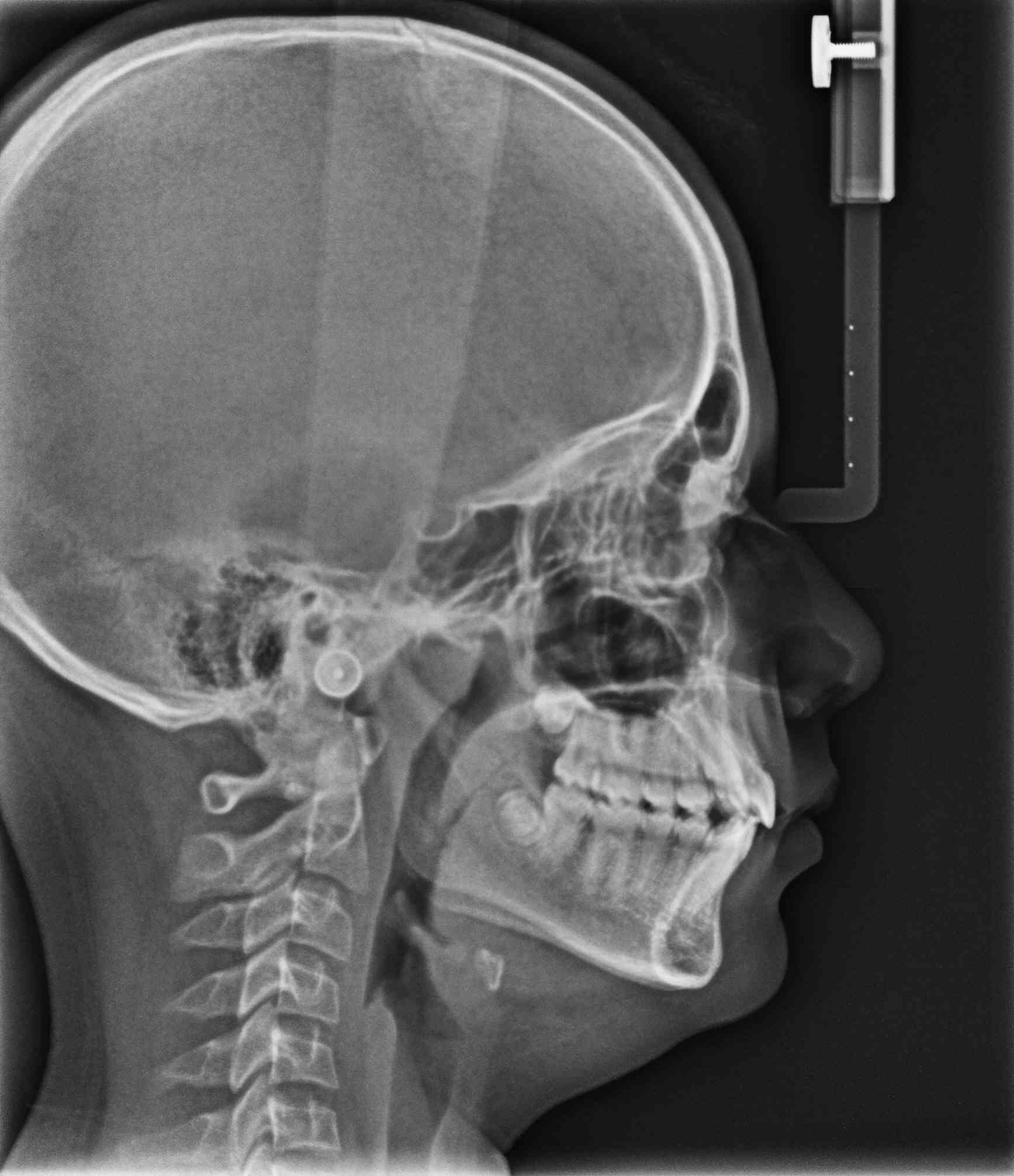 yolo bone Object Detection Dataset by Joydip Sarkar