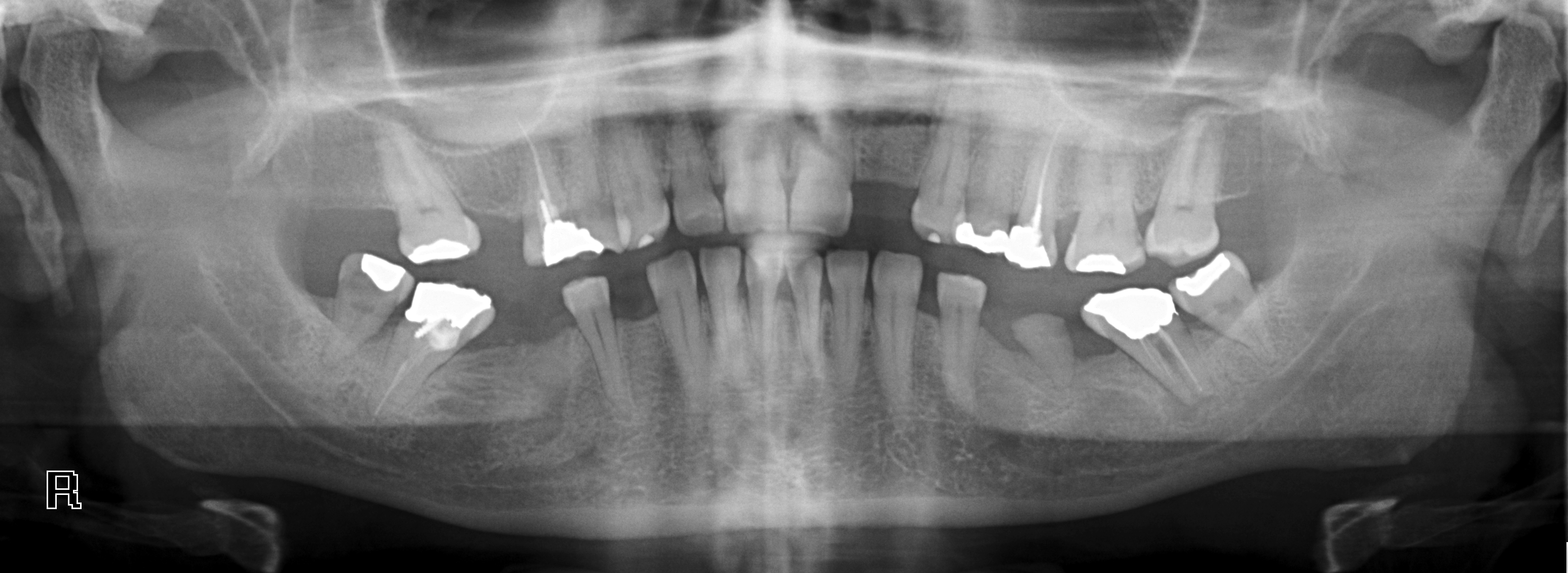 Tooth Label in Panoramic X-ray Semantic Segmentation Dataset and Pre ...