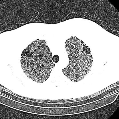 lung Object Detection Dataset by Mela