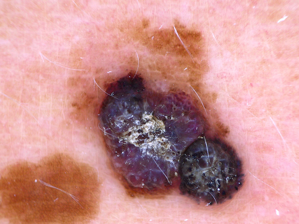 Detection of Skin cancer's types Classification Dataset by ...