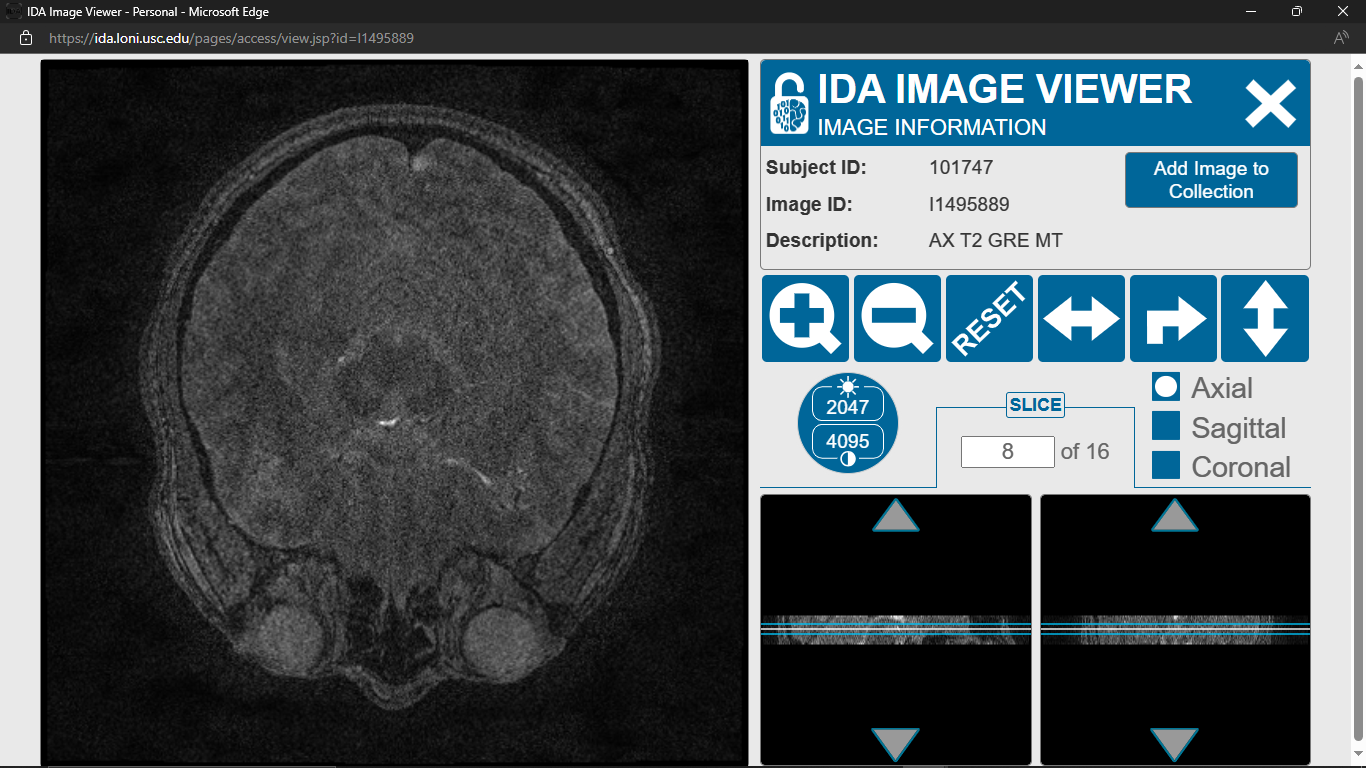 parkinsons Object Detection Dataset and Pre-Trained Model by sheeshyma