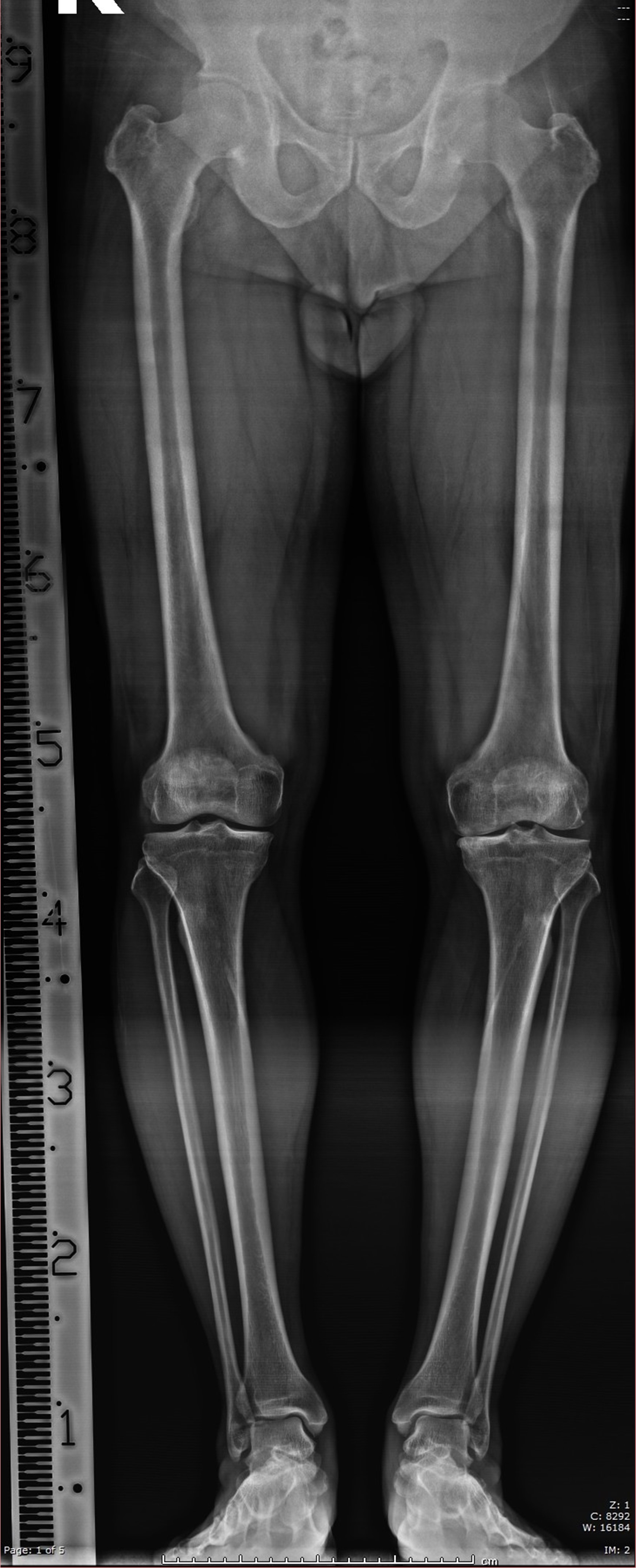 Femoral_head_segmentation Instance Segmentation Dataset and Pre-Trained Model by HKANWM
